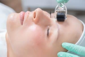 Microneedling: Benefits, Side Effects, Cost, Results